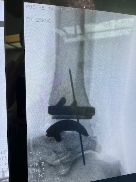 Ankle Pain No More: JHAH Orthopedics Performs a Surgical First | Johns ...